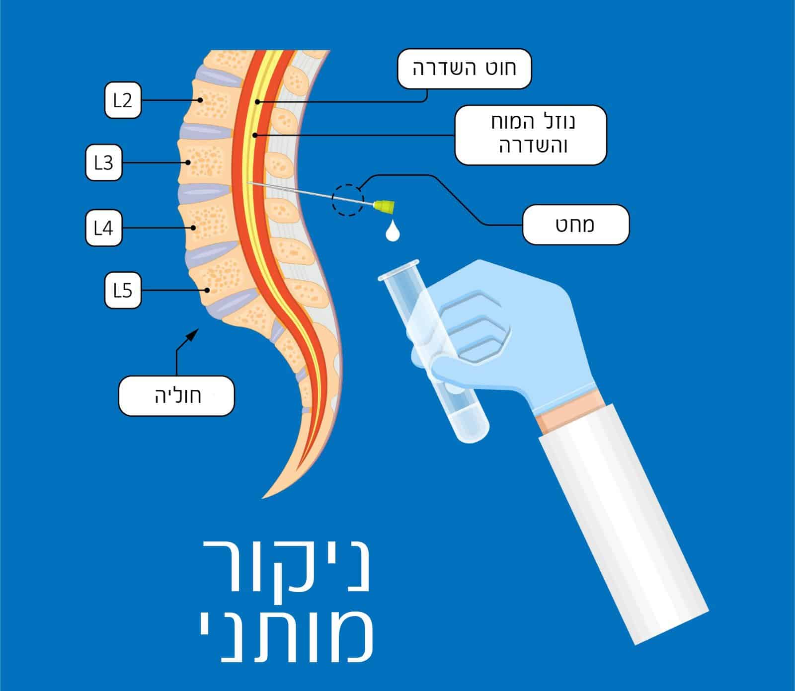 ניקור מותני ומקרים של רשלנות רפואית - באילו מקרים ניתן להגיש תביעה?
