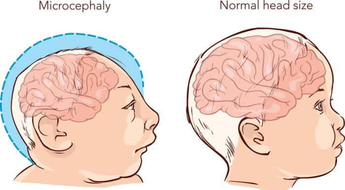 רשלנות רפואית, מיקרוצפליה ונזקים לילוד - עורך דין שמואל קשיוב