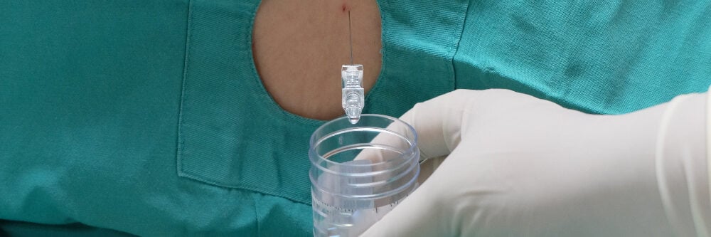 ניקור מותני ומקרים של רשלנות רפואית - באילו מקרים ניתן להגיש תביעה?